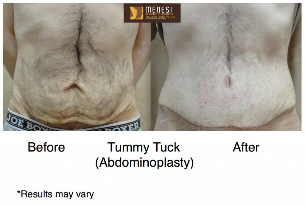 Tummy Tuck – Male – Dr. Wisam Menesi